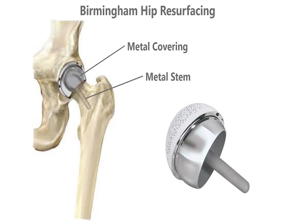 Birmingham Hip Resurfacing BHR in India - Heed Health