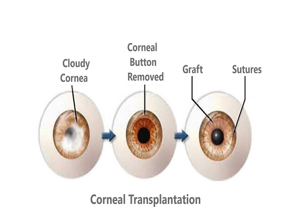 Corneal Transplantation Eye Transplant - Heed Health